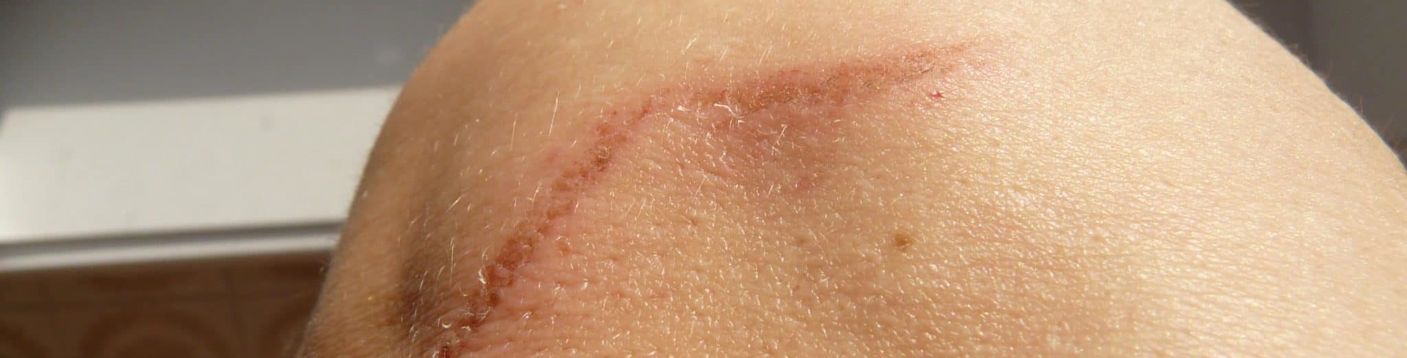 Scar Revisions | Advanced Hearing Hawaii